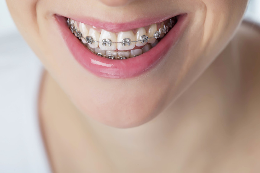Getting Braces And Finding My Smile At 42 The Saturday Evening Post